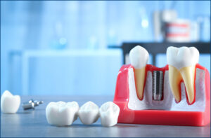 Dental Bridges Explained: How They Work and When They’re Needed